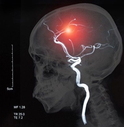 The Invention of Warfarin - American Chemical Society